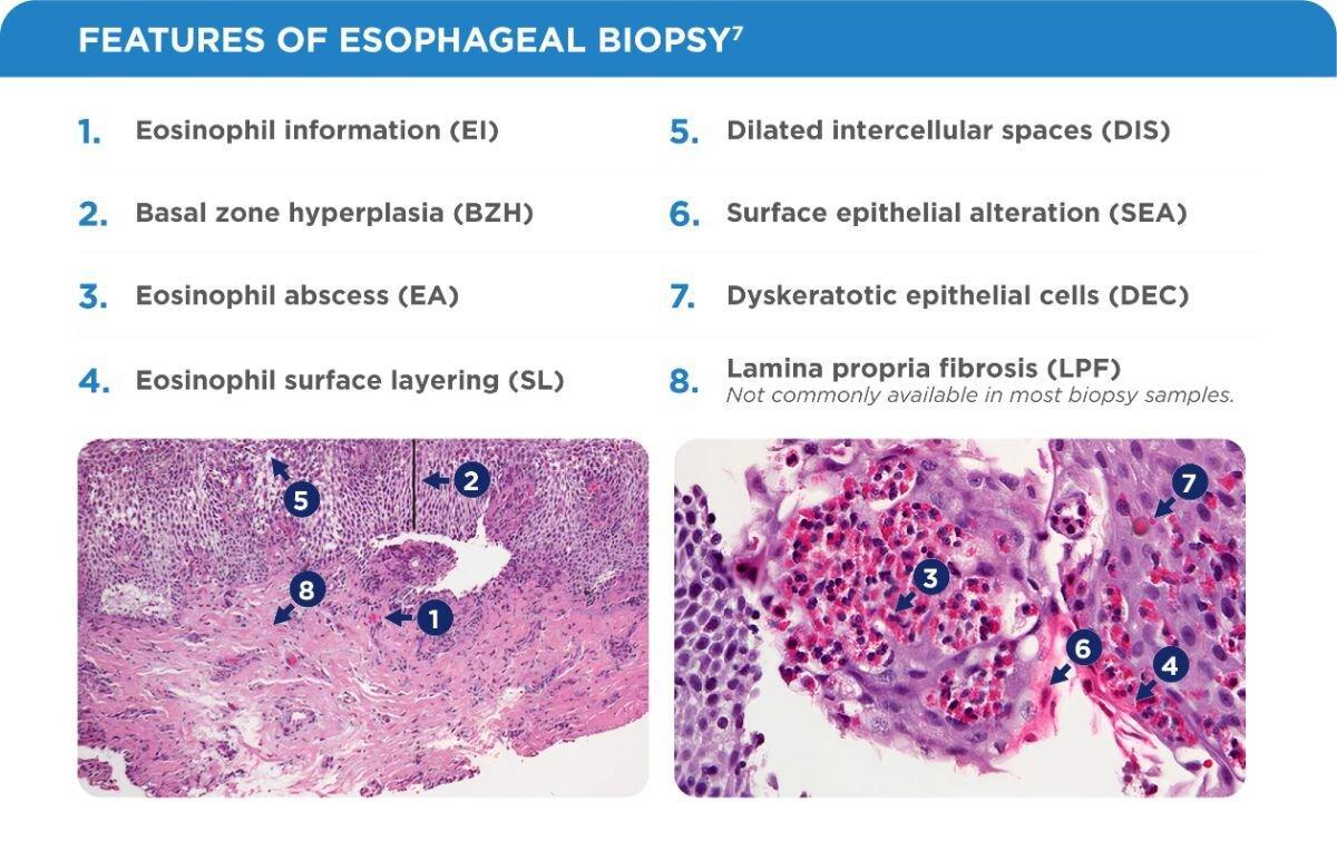 Pathology Outlines Eosinophilic Esophagitis Pathology Of Eosinophilic